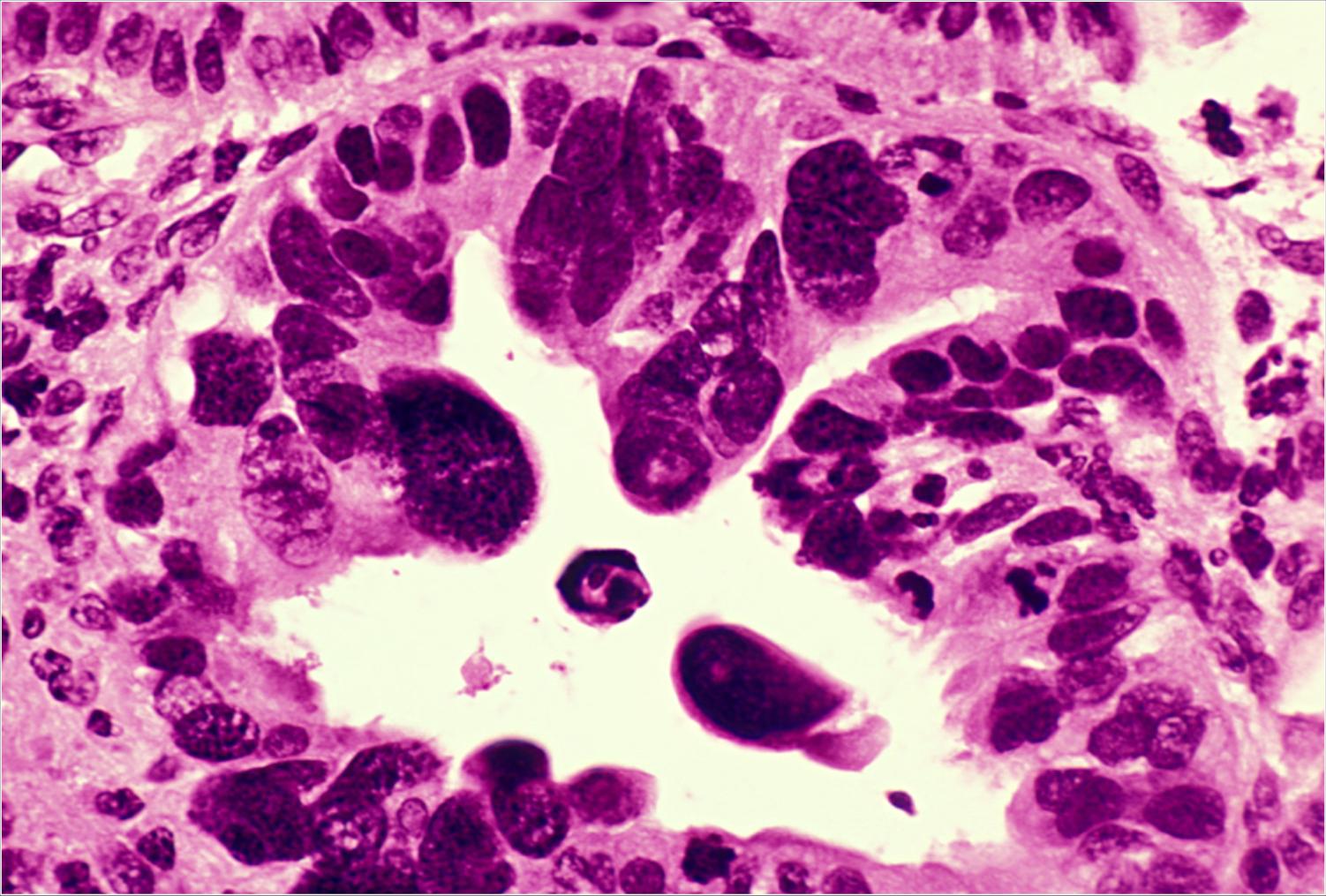 adenocarcinoma | Pathology Student