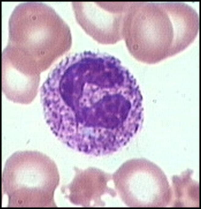 toxic granulation and Dohle body | Pathology Student