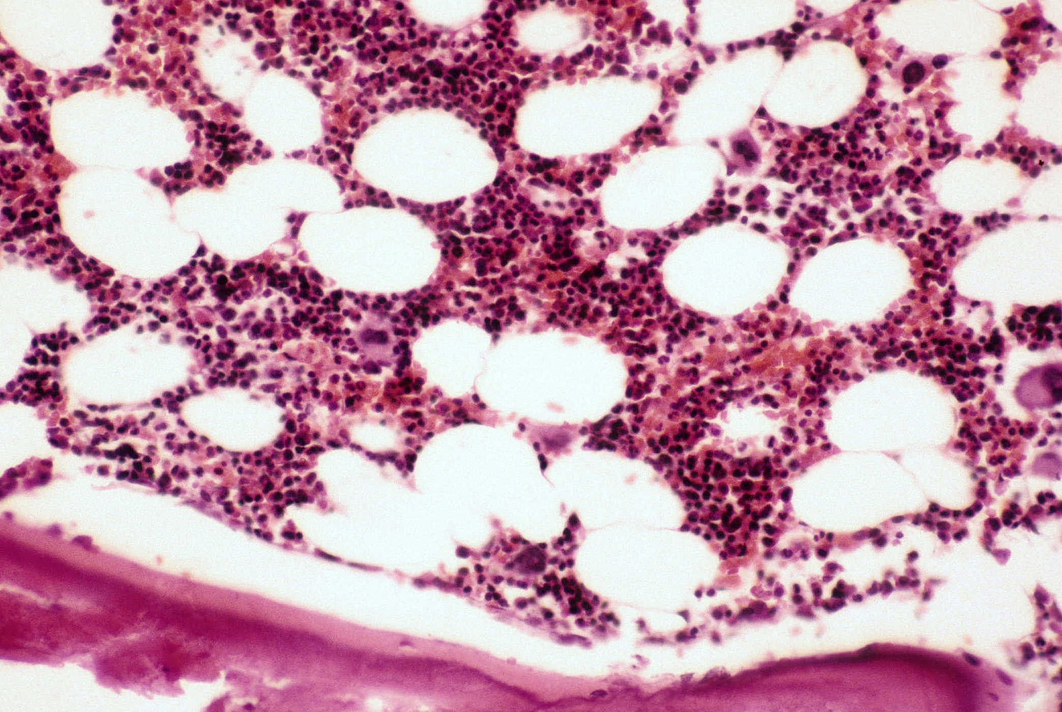 normal marrow | Pathology Student