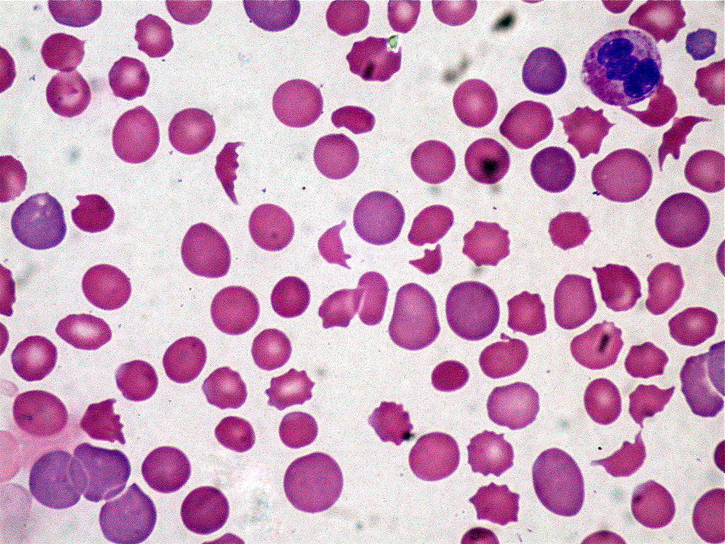 Microangiopathic Hemolytic Anemia Pathology Student