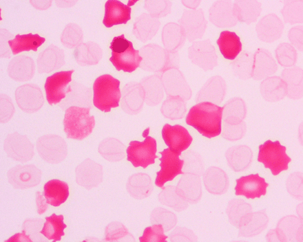 What’s the Kleihauer-Betke test used for? | Pathology Student