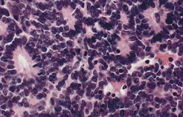 The four main types of rosettes in pathology | Pathology Student