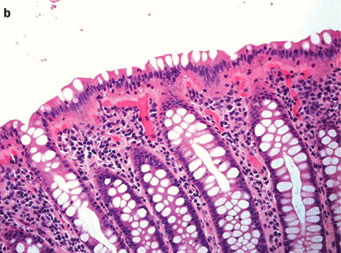 Colitis, Collagenous