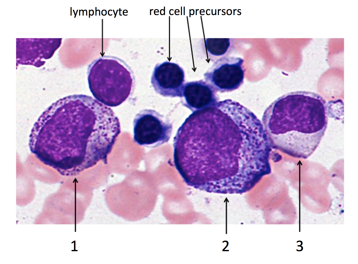 How To Tell Apart Promyelocytes And Myelocytes Pathology Student